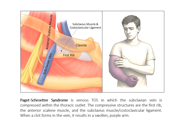 Thoracic Outlet Syndrome - Thoracic Surgery | UCLA Health