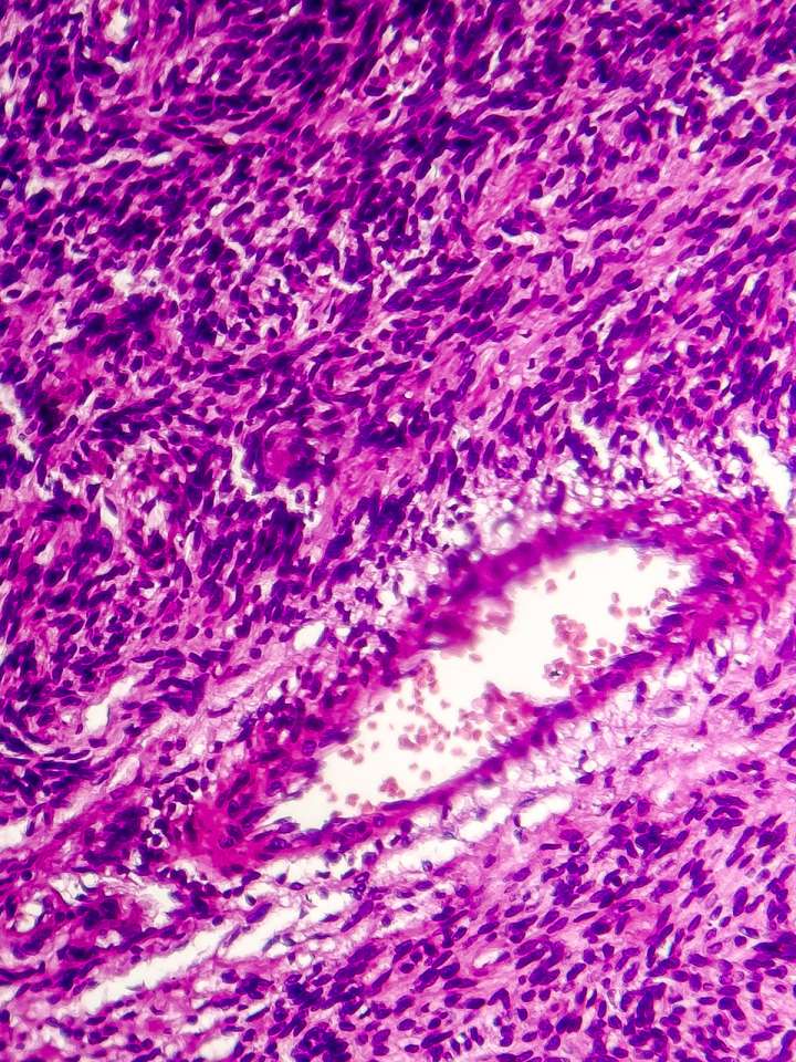 Sarcoma Cancer Care | UCLA Health Jonsson Comprehensive Cancer Center