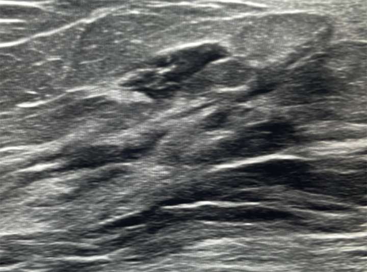 Lymphoma of the Breast - Radiology | UCLA Health