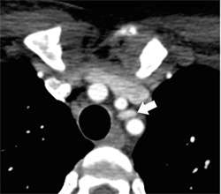 Parathyroid 4D-CT Scan - Endocrine Surgery | UCLA Health