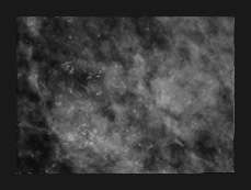 Mammography: Calcifications - Radiology | UCLA Health