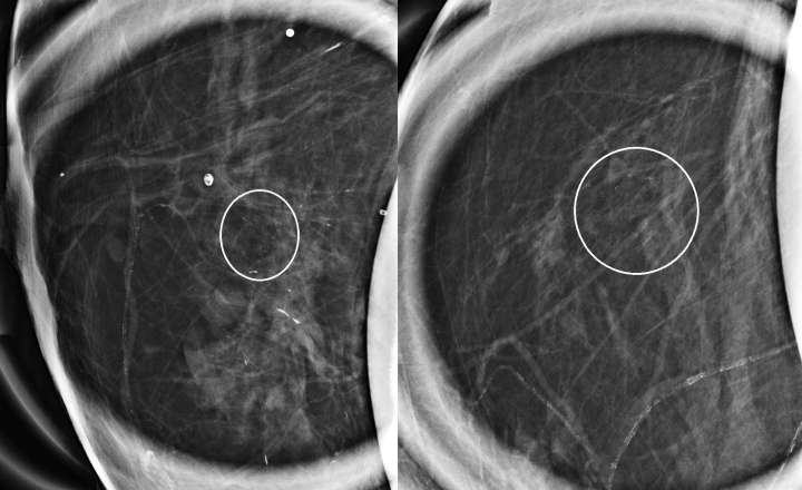 Case: Atypical Ductal Hyperplasia - Radiology | UCLA Health