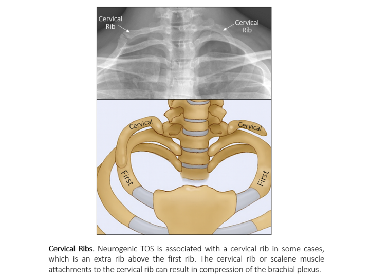 Thoracic Outlet Syndrome - Thoracic Surgery | UCLA Health