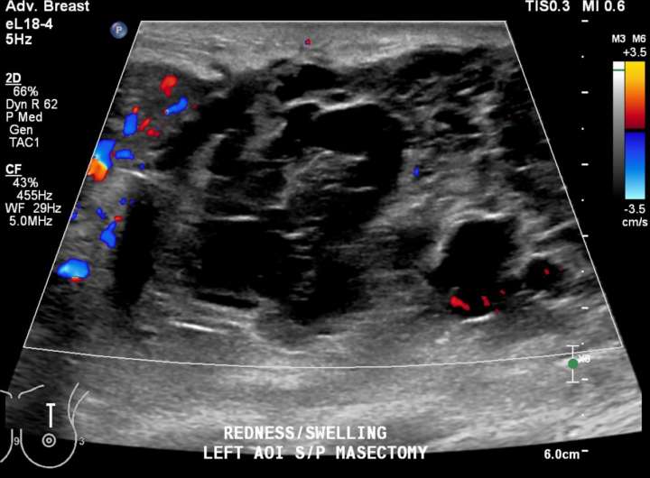 Post-Surgical Fluid Collections: Causes, Symptoms, and Management - Radiology | UCLA Health