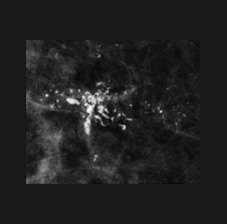 Mammography: Calcifications - Radiology | UCLA Health