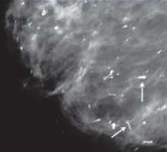 Mammography: Calcifications - Radiology | UCLA Health