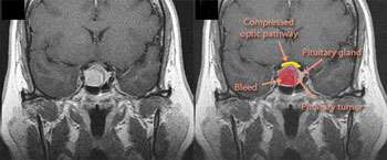 Pituitary Apoplexy - Pituitary & Skull Base Tumor | UCLA Health