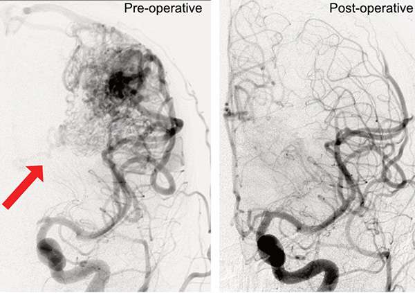 Arteriovenous Malformations (AVM) - Cerebrovascular Disease | UCLA Health