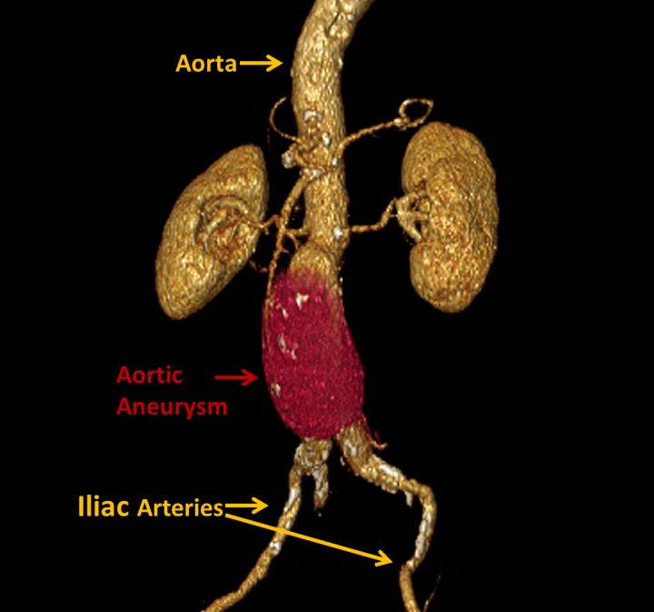Aneurysm and Dissection - Interventional Radiology | UCLA Health