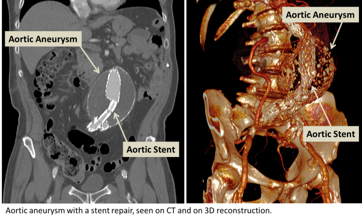 Aneurysm and Dissection - Interventional Radiology | UCLA Health