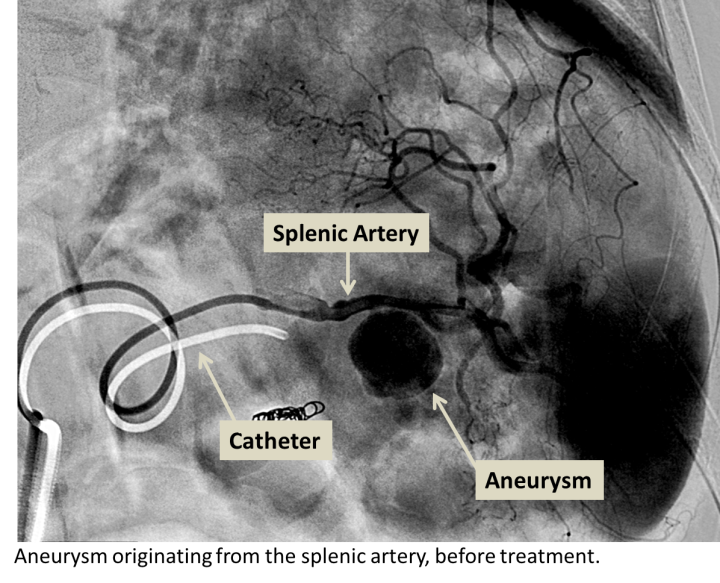 Aneurysm and Dissection - Interventional Radiology | UCLA Health