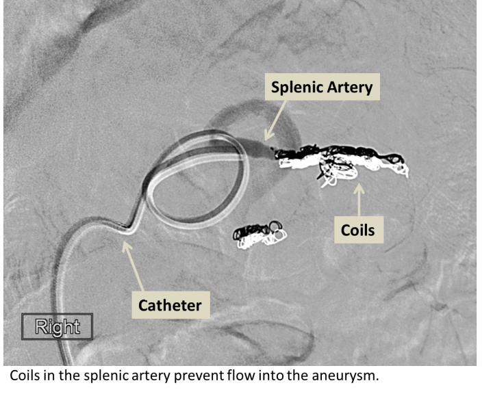 Aneurysm and Dissection - Interventional Radiology | UCLA Health