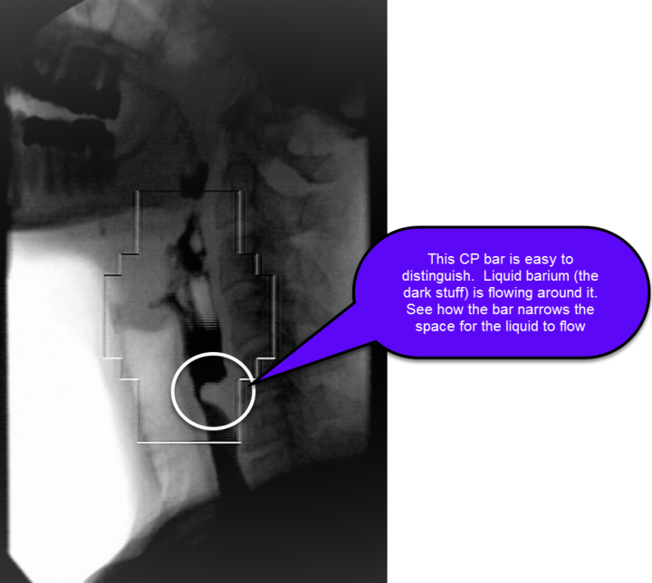 Cricopharyngeal Bar - Esophageal Health | UCLA Health