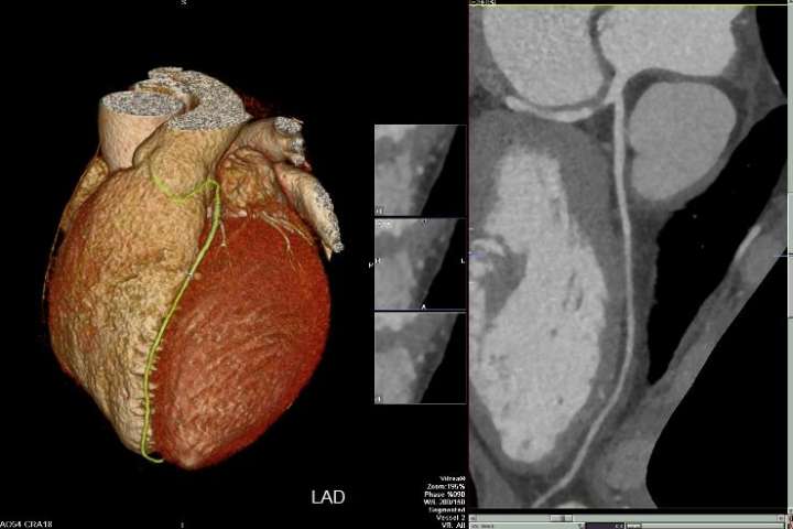 Cardiovascular - Q3D Imaging Lab | UCLA Health