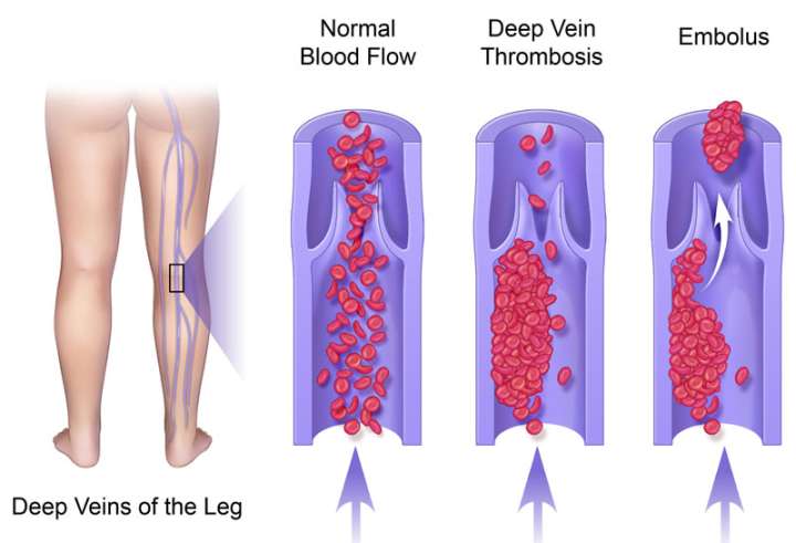 Deep Vein Thrombosis (DVT) - Pulmonary Vascular Disease | UCLA Health