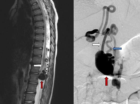 Spinal Vascular Malformations - Cerebrovascular Disease | UCLA Health