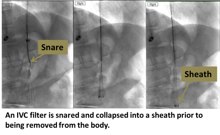 IVC Filter Removal - IVC Filter | UCLA Health