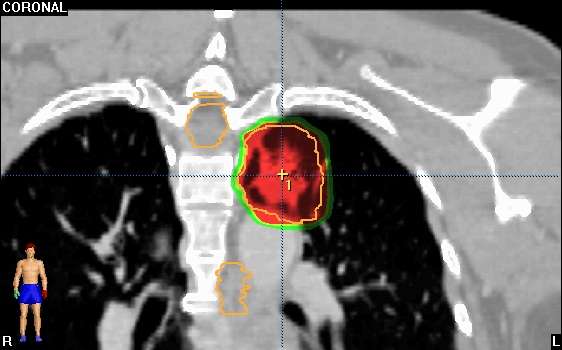SBRT (Stereotactic Body Radiation Therapy) FAQs - Radiation Oncology ...