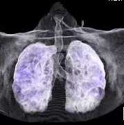 SBRT (Stereotactic Body Radiation Therapy) FAQs - Radiation Oncology ...