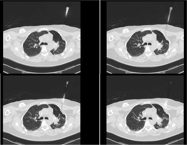 SBRT (Stereotactic Body Radiation Therapy) FAQs - Radiation Oncology ...