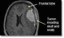 Meningioma Brain Tumor - Neurosurgery | UCLA Health