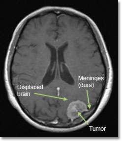 Meningioma Brain Tumor - Neurosurgery | UCLA Health