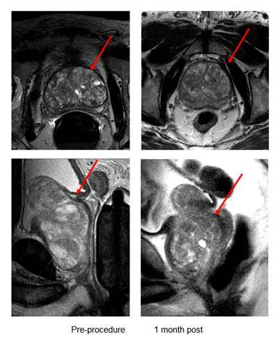 Prostate Artery Embolization - Prostate Imaging | UCLA Health