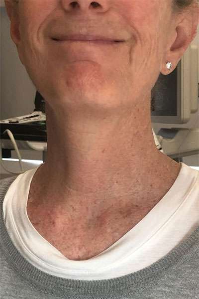 Parathyroidectomy Scar Photos - Parathyroid Surgery Scar Photos ...