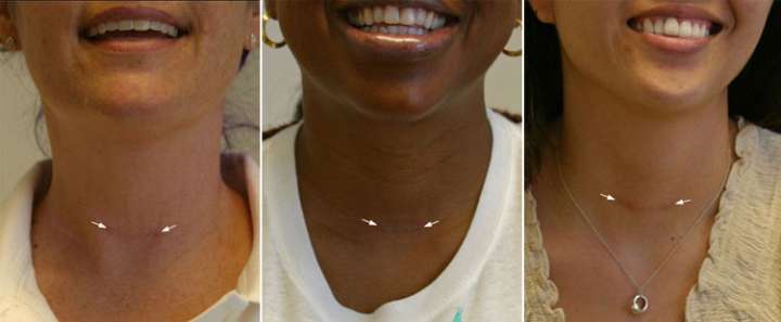 Thyroid Surgery - Thyroidectomy Surgery - Endocrine Surgery | UCLA Health