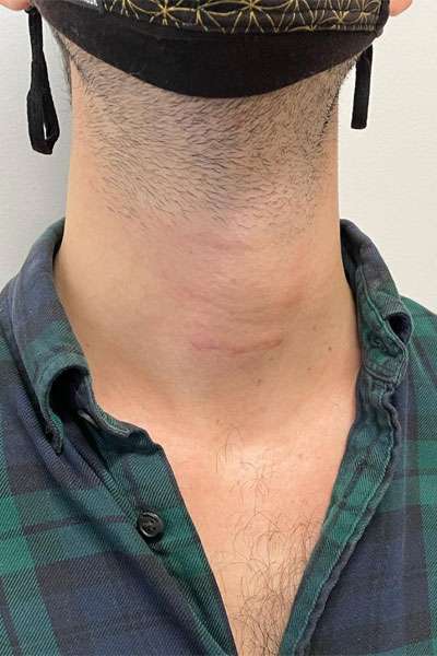Thyroidectomy Scar Photos - Thyroid Cancer Surgery Scars - Endocrine ...