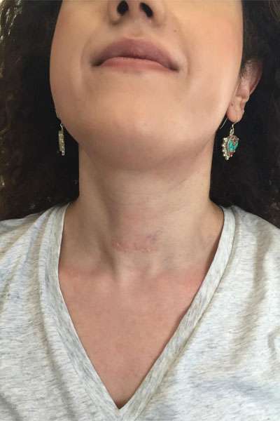Scar Photos - Thyroid Cancer Surgery, Thyroidectomy - Endocrine Surgery ...