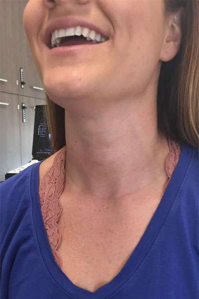 Thyroidectomy Scar Photos - Thyroid Cancer Surgery Scars - Endocrine ...