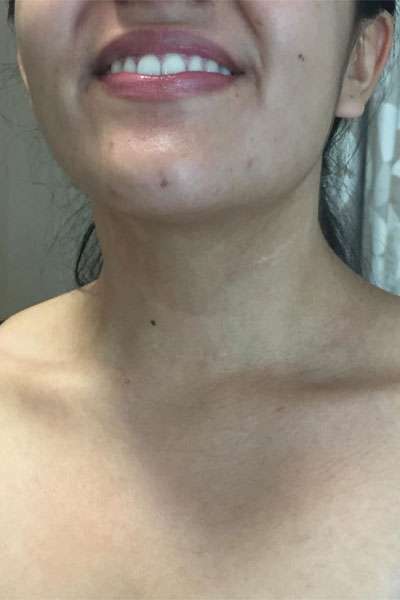 Thyroidectomy Scar Photos - Thyroid Cancer Surgery Scars - Endocrine ...