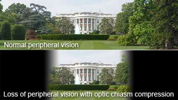 Nelson's Syndrome - Pituitary & Skull Base Tumor | UCLA Health