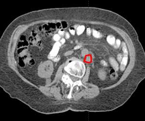 SBRT (Stereotactic Body Radiation Therapy) FAQs - Radiation Oncology ...