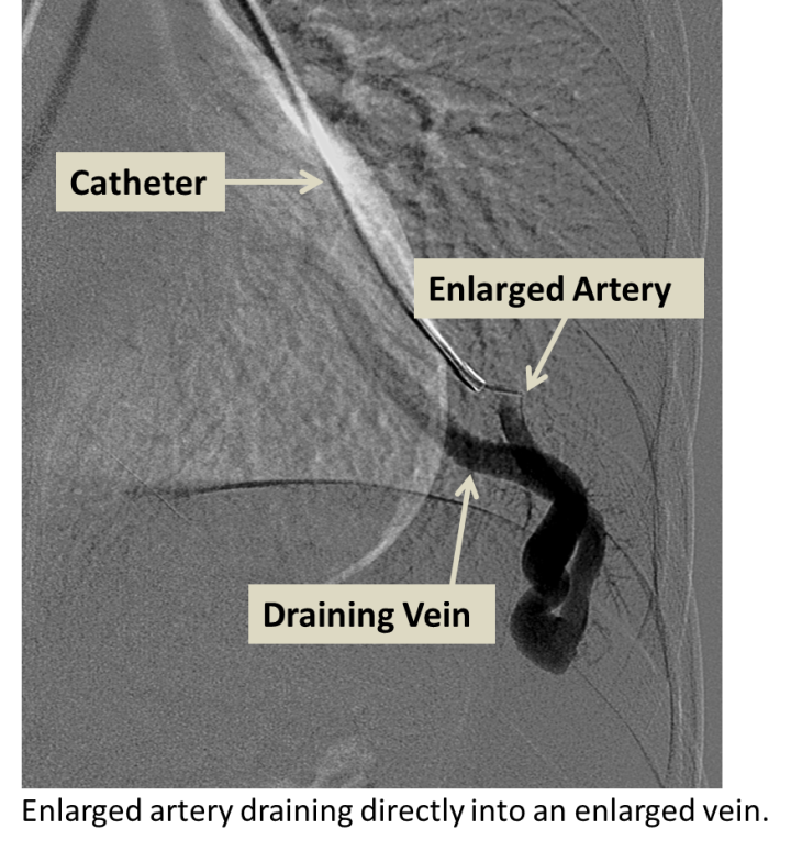 Pulmonary Arteriovenous Malformations (AVM) - Interventional Radiology ...