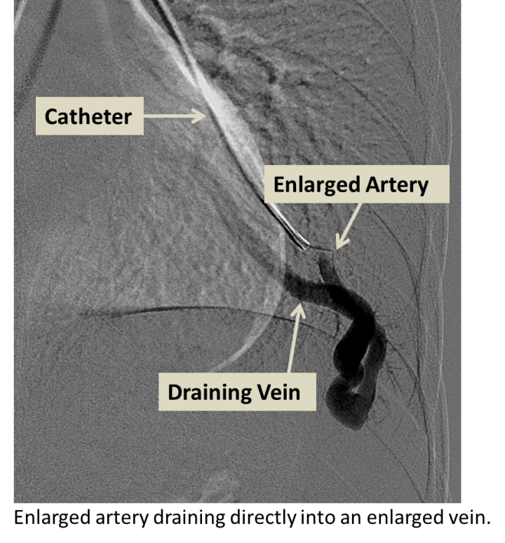 Pulmonary Arteriovenous Malformations (AVM) - Interventional Radiology ...