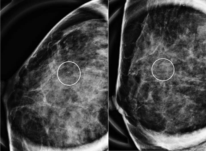 Case: Atypical Ductal Hyperplasia - Radiology | UCLA Health