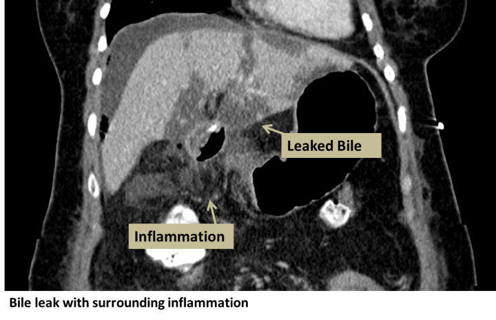 Biliary Leak - Interventional Radiology | UCLA Health
