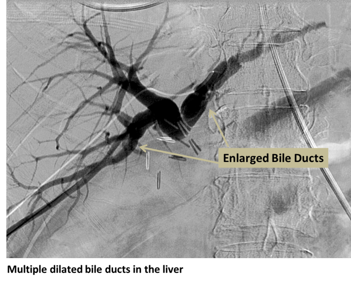 Biliary Obstruction - Interventional Radiology | UCLA Health