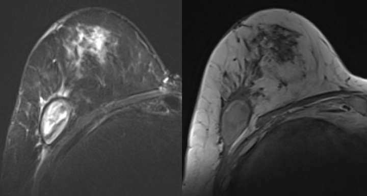 Post-Surgical Fluid Collections: Causes, Symptoms, and Management ...