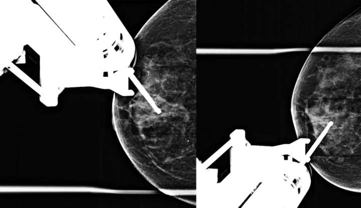 How to Perform: Stereotactic (Mammographic Guided Biopsy) - Radiology ...