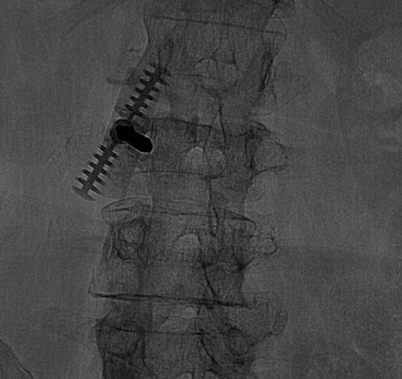 Vertebroplasty / Kyphoplasty / Sacroplasty - Interventional ...