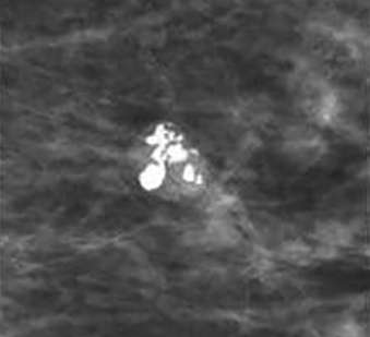 Mammography: Calcifications - Radiology | UCLA Health