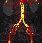 Dual Energy CT Angiography - Radiology | UCLA Health