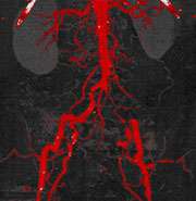 Dual Energy CT Angiography - Radiology | UCLA Health