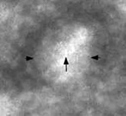 Mammography: Calcifications - Radiology | UCLA Health