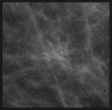 Mammography: Calcifications - Radiology | UCLA Health