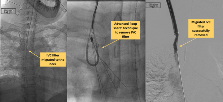 IVC Filter Migration - IVC Filter | UCLA Health