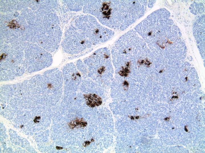Hyperinsulinism - Pediatric Endocrinology | UCLA Health